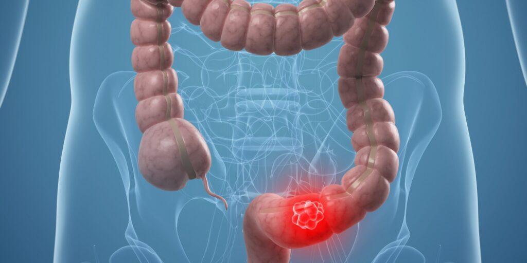 Luchemos contra el cáncer de colon: causas, síntomas, prevención y ...