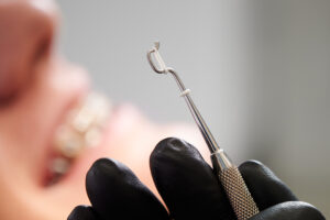 ¿Para qué sirven las gomas en Invisalign? - Ribera Dent